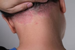 Scalp Psoriasis: What You Need to Know | Cascade Eye & Skin Centers
