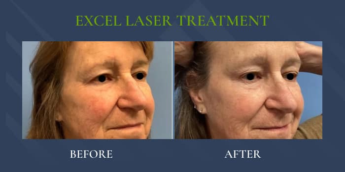 Excel V & PDL - Cascade Eye & Skin Centers