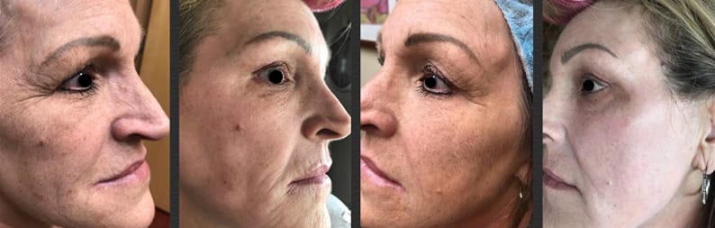 Fraxel Lasers & Clear Brilliant - Cascade Eye & Skin Centers