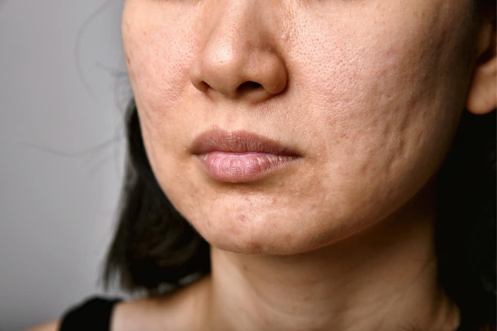 Laser Treatment for Acne Scars | Cascade Eye & Skin Centers