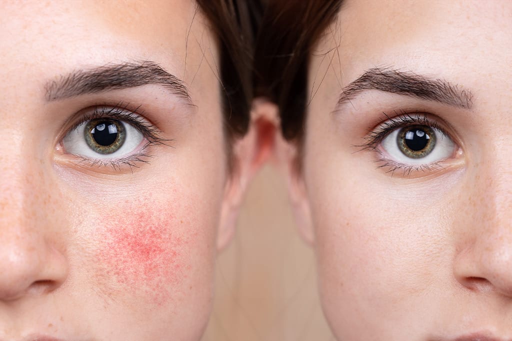 Laser Treatment for Rosacea | Cascade Eye & Skin Centers