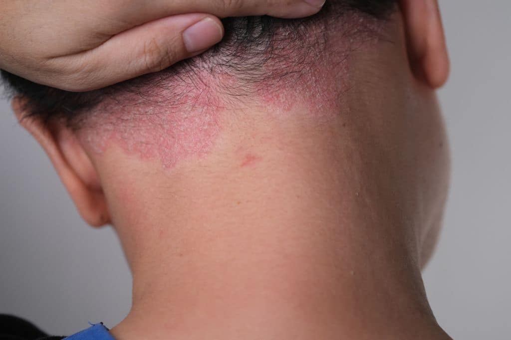 Scalp Psoriasis: What You Need to Know | Cascade Eye & Skin Centers